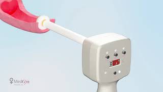 MedGyn MTA-100 Thermal Ablation System - MedGyn